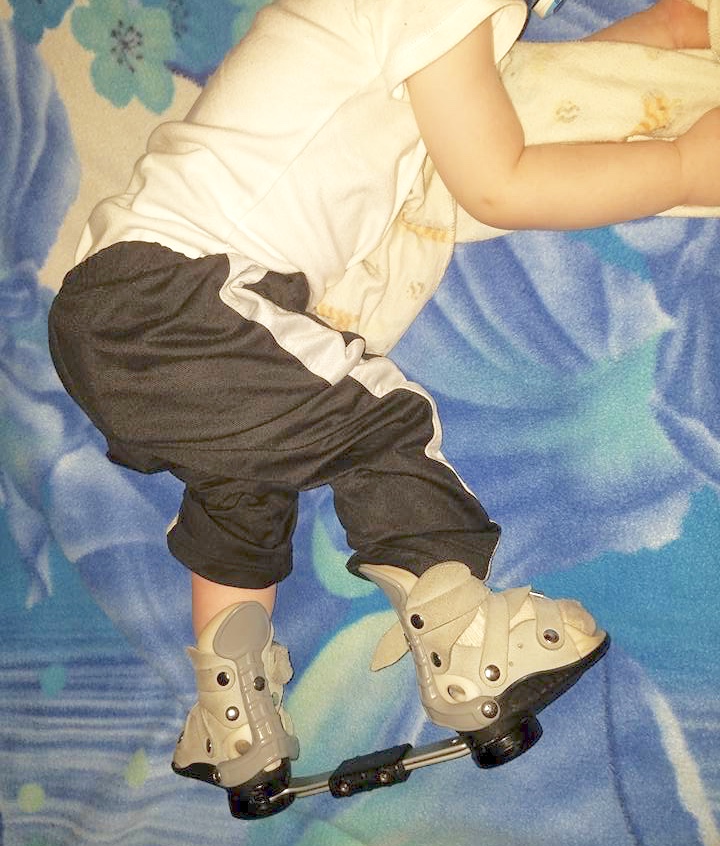 Unilateral Clubfoot Bracing – Momma Maven